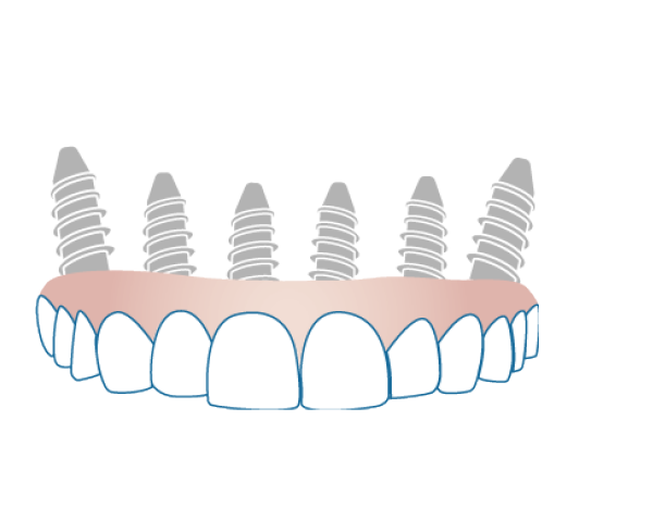 Zygomatic Implants - Dental Implants GPS