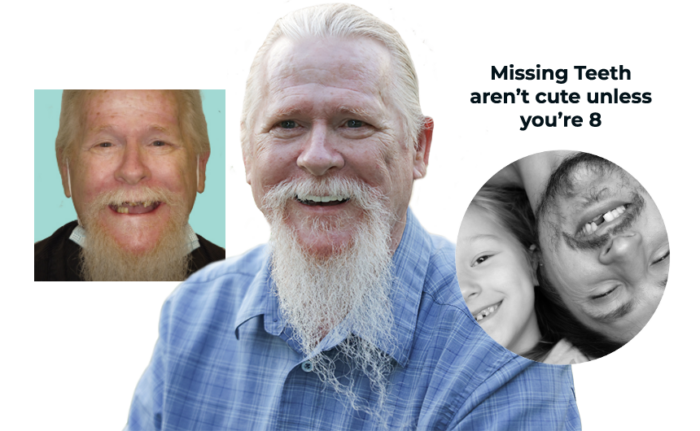 Dental Implant Options for Missing and Failing Teeth - Dental Implants GPS