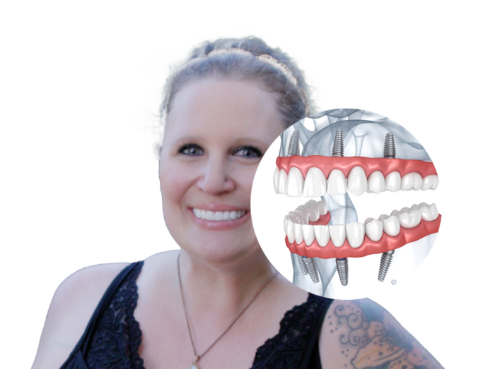 Full-Arch Dental implants - Dental Implants GPS