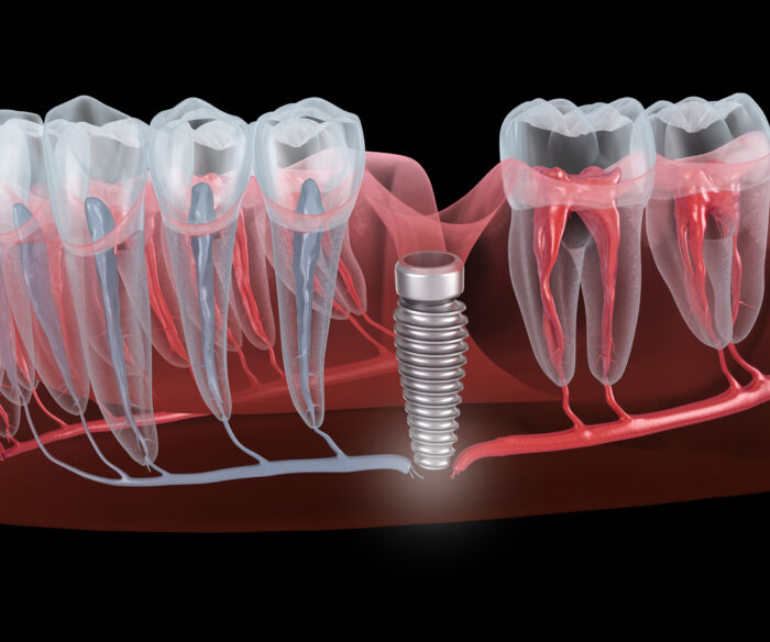When Are Dental Implants Medically Necessary? - GPS Dental Implants